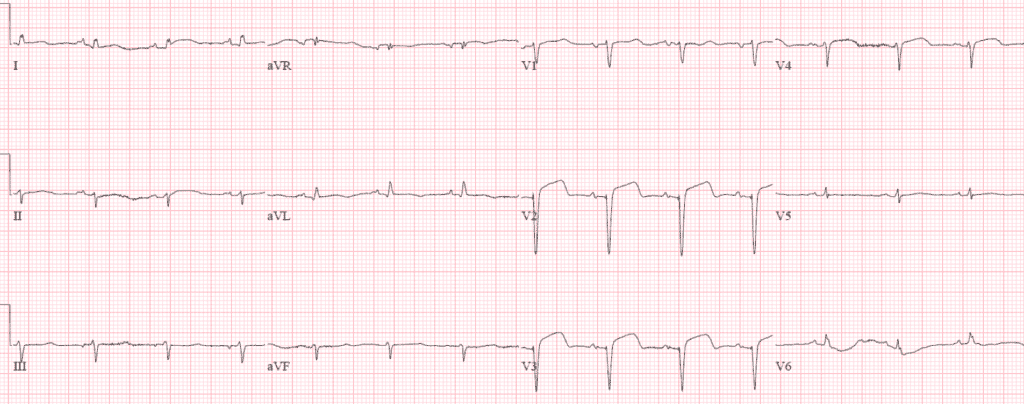 ECG in Weakness and Neurological symptoms | ECG Cases | EM Cases