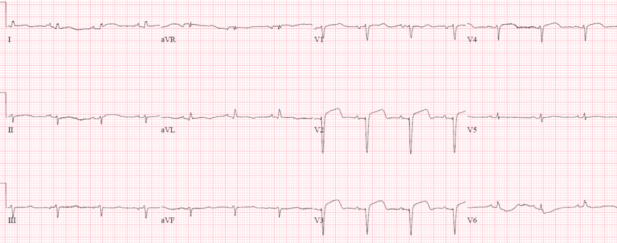 ECG in Weakness and Neurological symptoms | ECG Cases | EM Cases