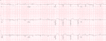 ECG in Weakness and Neurological symptoms | ECG Cases | EM Cases