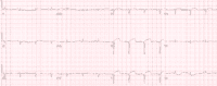 ECG in Weakness and Neurological symptoms | ECG Cases | EM Cases