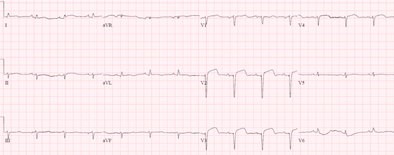 ECG in Weakness and Neurological symptoms | ECG Cases | EM Cases