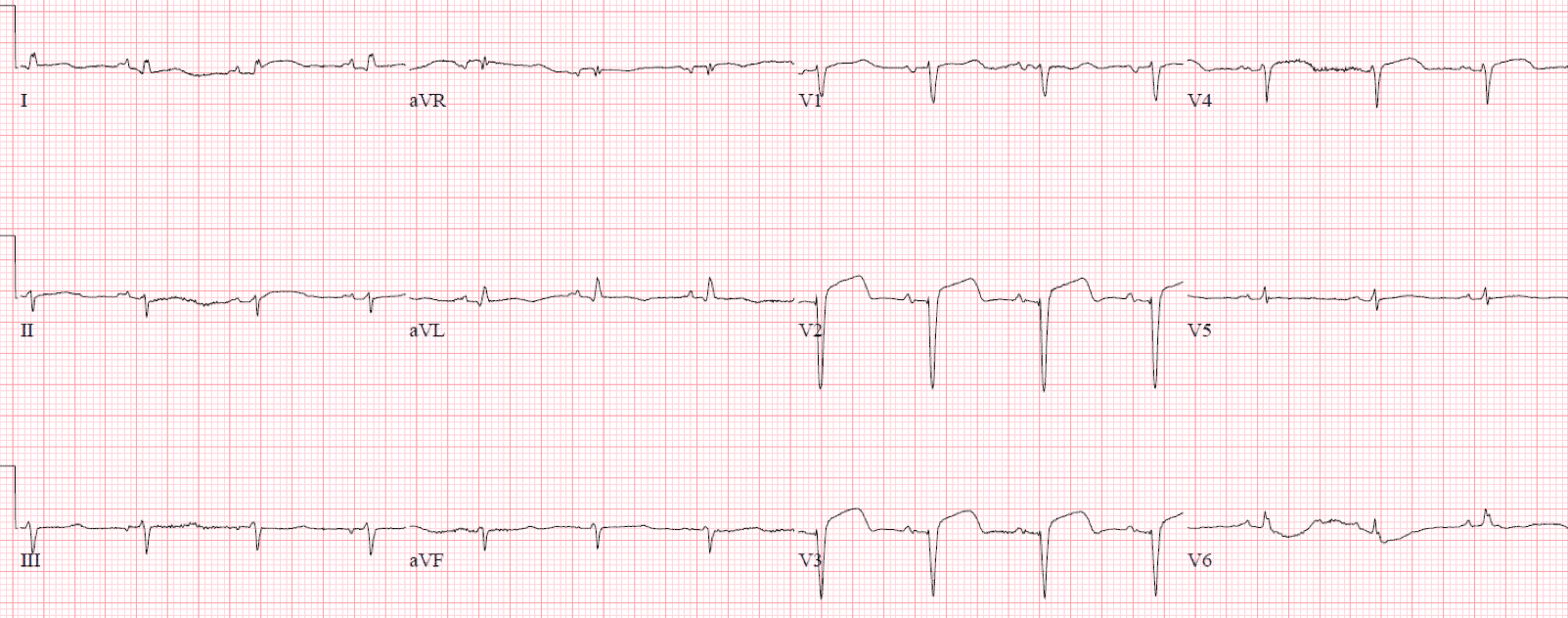 ECG in Weakness and Neurological symptoms | ECG Cases | EM Cases