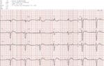 ECG in Weakness and Neurological symptoms | ECG Cases | EM Cases