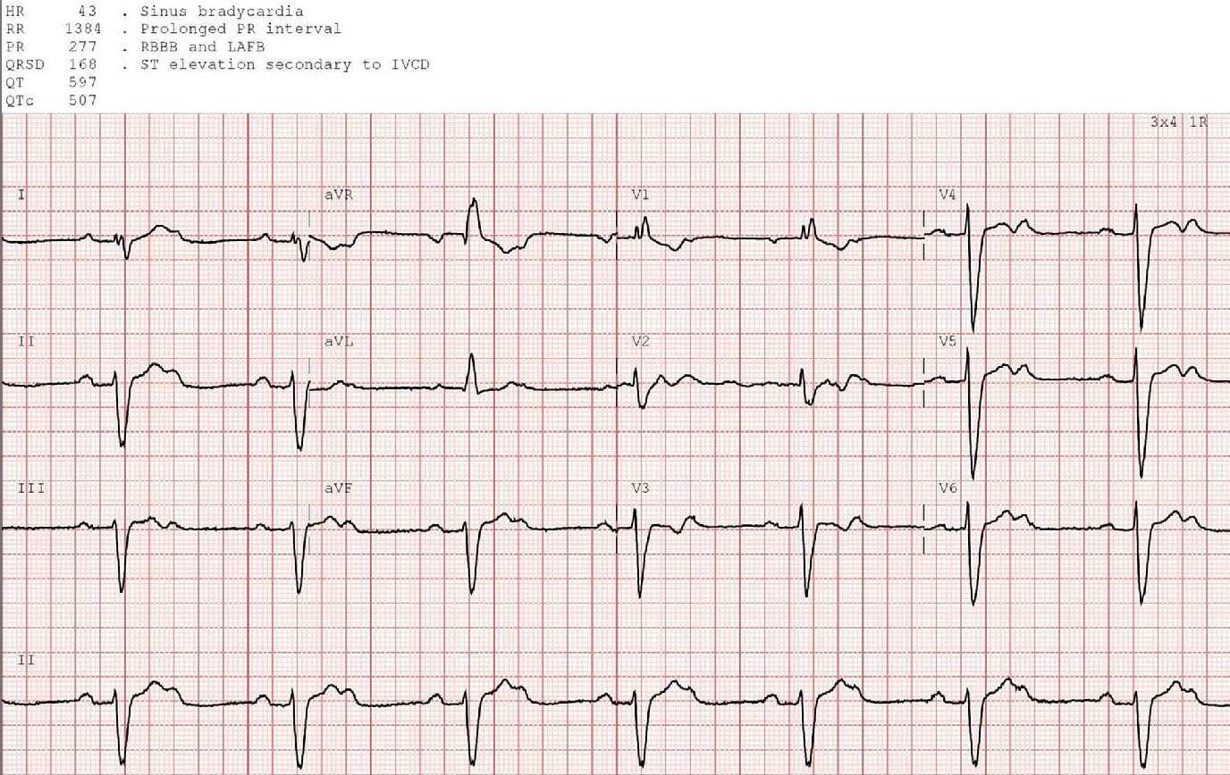 ECG in Weakness and Neurological symptoms | ECG Cases | EM Cases