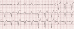 ECG in Weakness and Neurological symptoms | ECG Cases | EM Cases
