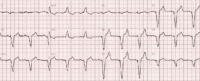 ECG in Weakness and Neurological symptoms | ECG Cases | EM Cases