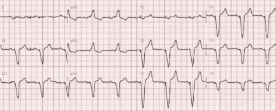ECG in Weakness and Neurological symptoms | ECG Cases | EM Cases