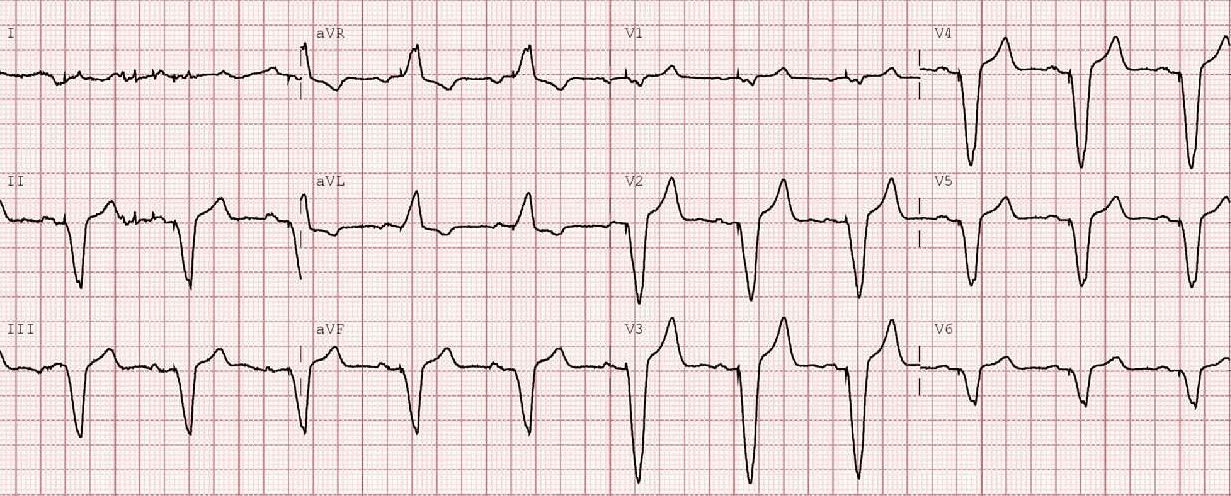 ECG in Weakness and Neurological symptoms | ECG Cases | EM Cases