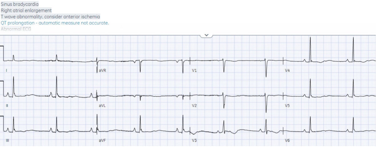 ECG en Debilidad y Síntomas Neurológicos | Casos de ECG ...