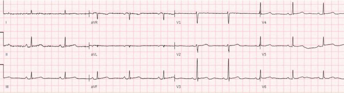 ECG in Weakness and Neurological symptoms | ECG Cases | EM Cases