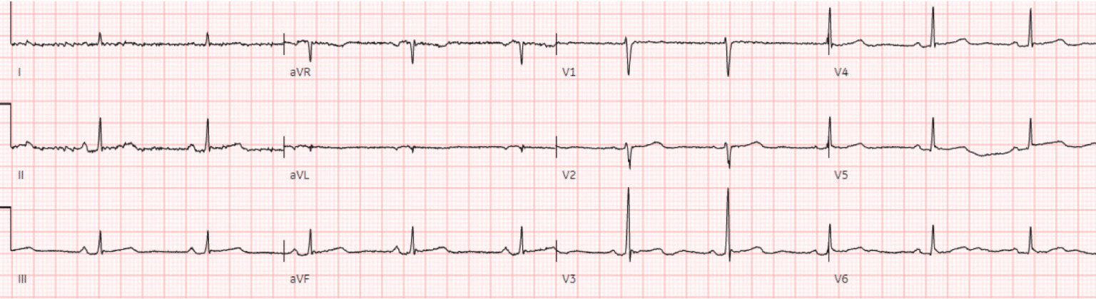 ECG in Weakness and Neurological symptoms | ECG Cases | EM Cases