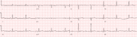 ECG in Weakness and Neurological symptoms | ECG Cases | EM Cases