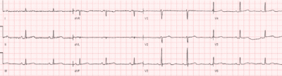 ECG in Weakness and Neurological symptoms | ECG Cases | EM Cases