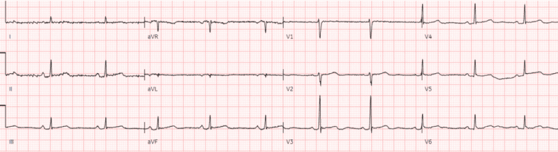 ECG in Weakness and Neurological symptoms | ECG Cases | EM Cases