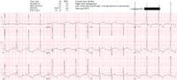 ECG in Weakness and Neurological symptoms | ECG Cases | EM Cases
