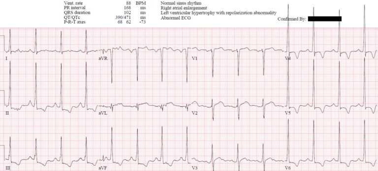 ECG in Weakness and Neurological symptoms | ECG Cases | EM Cases