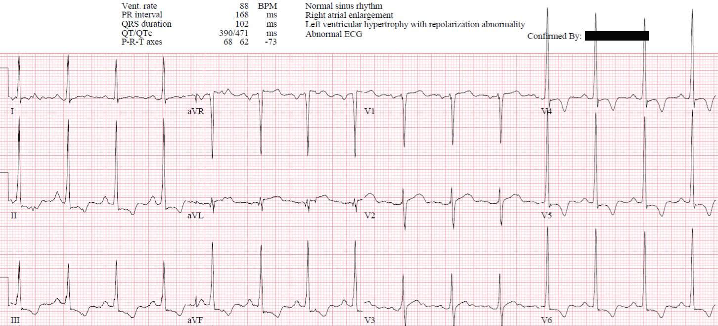 ECG in Weakness and Neurological symptoms | ECG Cases | EM Cases