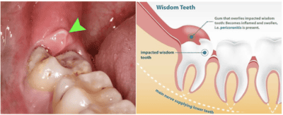 Atraumatic Dental Emergencies | Emergency Medicine Cases
