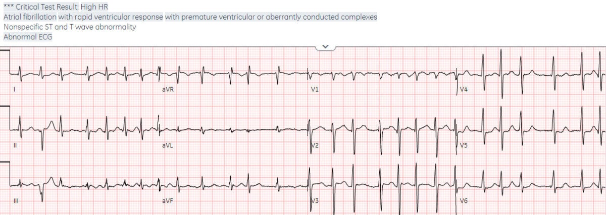 The ECG in fever and infectious disease | ECG Cases