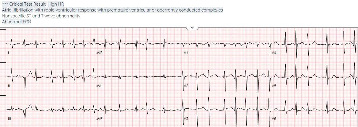 The ECG in fever and infectious disease | ECG Cases