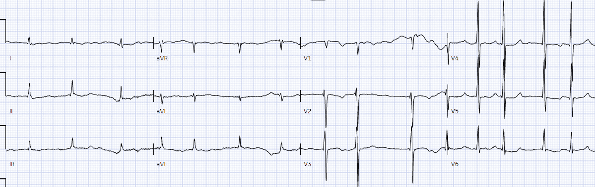 The ECG in fever and infectious disease | ECG Cases
