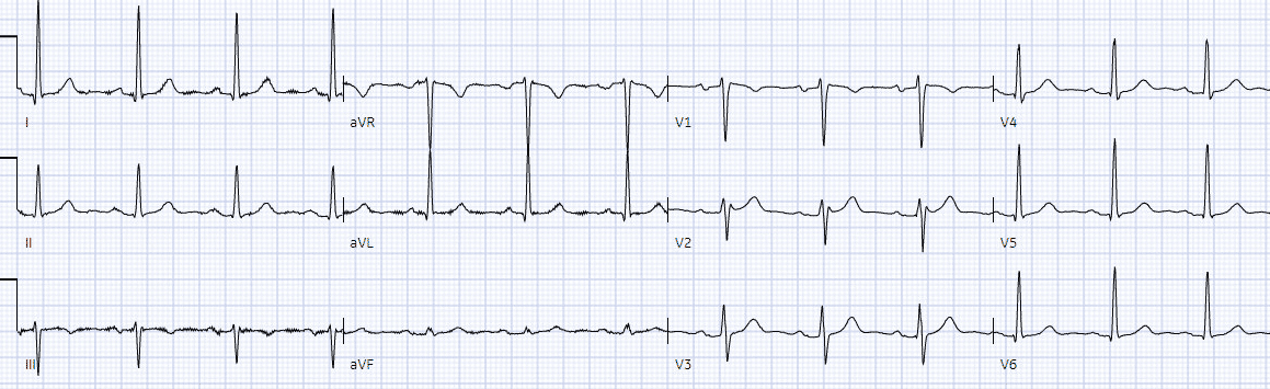 The ECG in fever and infectious disease | ECG Cases