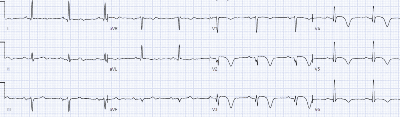 The ECG in fever and infectious disease | ECG Cases
