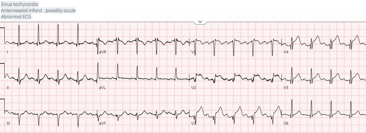 The ECG in fever and infectious disease | ECG Cases