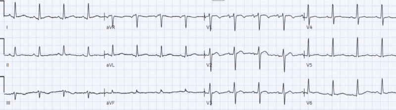 The ECG in fever and infectious disease | ECG Cases