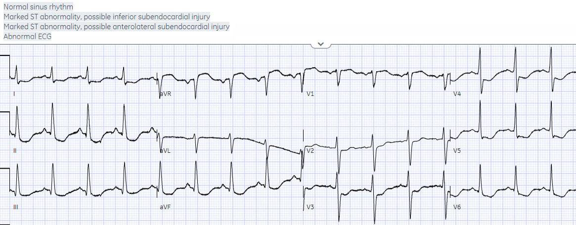 The ECG in fever and infectious disease | ECG Cases