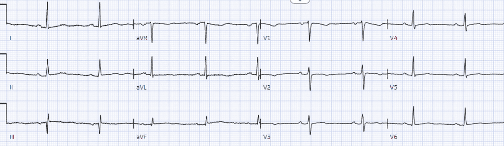 The ECG in fever and infectious disease | ECG Cases