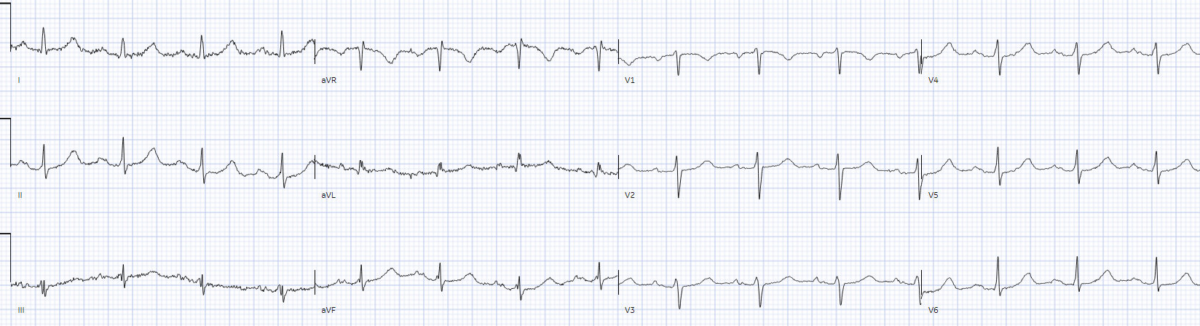 ECG Interpretation in Toxicology | ECG Cases | EM Cases