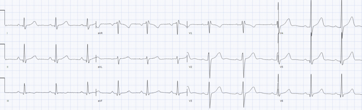 ECG Interpretation in Toxicology | ECG Cases | EM Cases