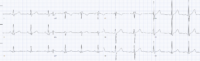 ECG Interpretation in Toxicology | ECG Cases | EM Cases