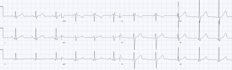 ECG Interpretation in Toxicology | ECG Cases | EM Cases