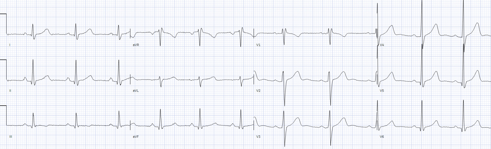 ECG Interpretation in Toxicology | ECG Cases | EM Cases
