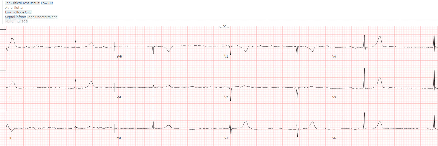 ECG Interpretation in Toxicology | ECG Cases | EM Cases