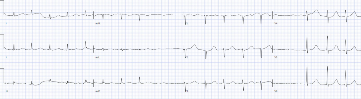 ECG Interpretation in Toxicology | ECG Cases | EM Cases