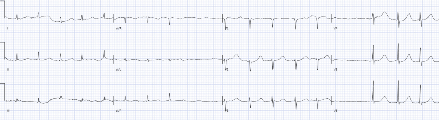 ECG Interpretation in Toxicology | ECG Cases | EM Cases