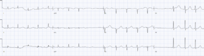ECG Interpretation in Toxicology | ECG Cases | EM Cases