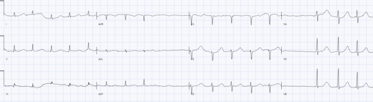 ECG Interpretation in Toxicology | ECG Cases | EM Cases