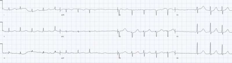 ECG Interpretation in Toxicology | ECG Cases | EM Cases
