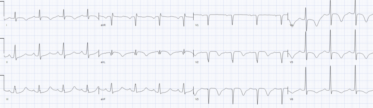 ECG Interpretation in Toxicology | ECG Cases | EM Cases