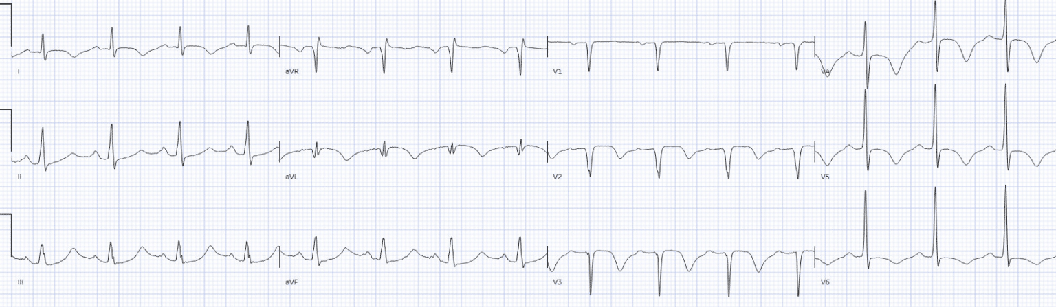 ECG Interpretation in Toxicology | ECG Cases | EM Cases