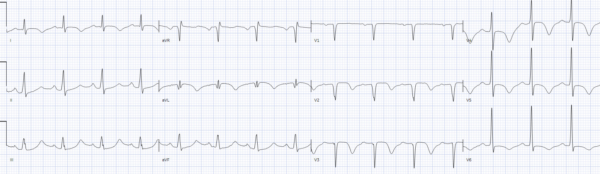ECG Interpretation in Toxicology | ECG Cases | EM Cases