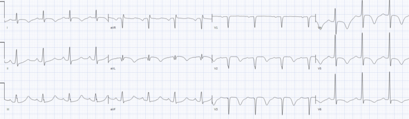 ECG Interpretation in Toxicology | ECG Cases | EM Cases