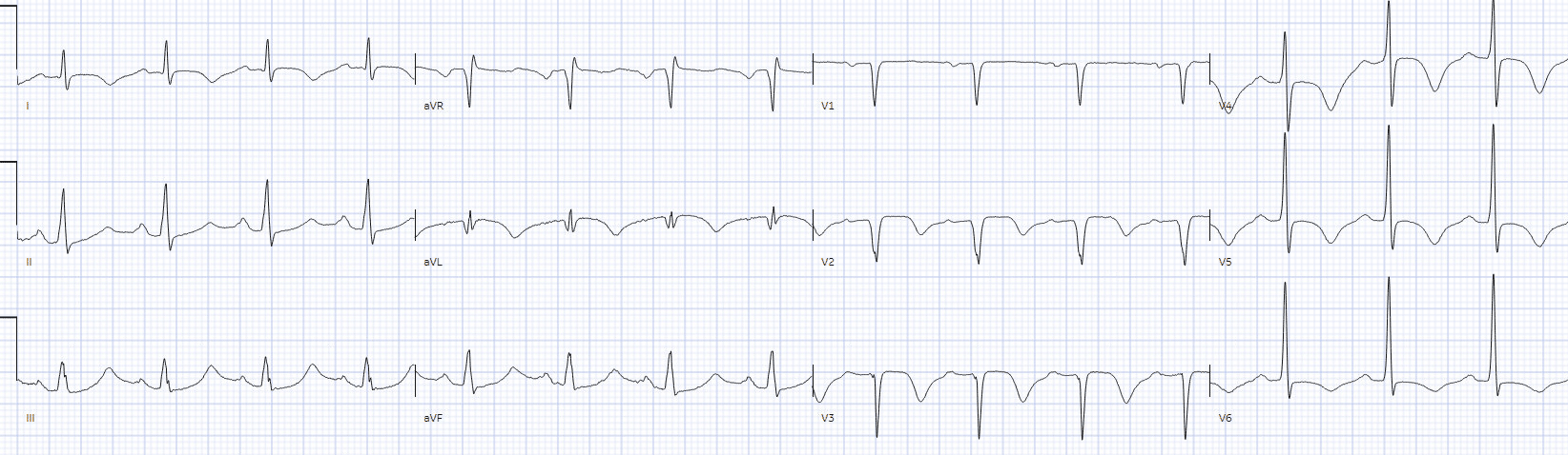 ECG Interpretation in Toxicology | ECG Cases | EM Cases