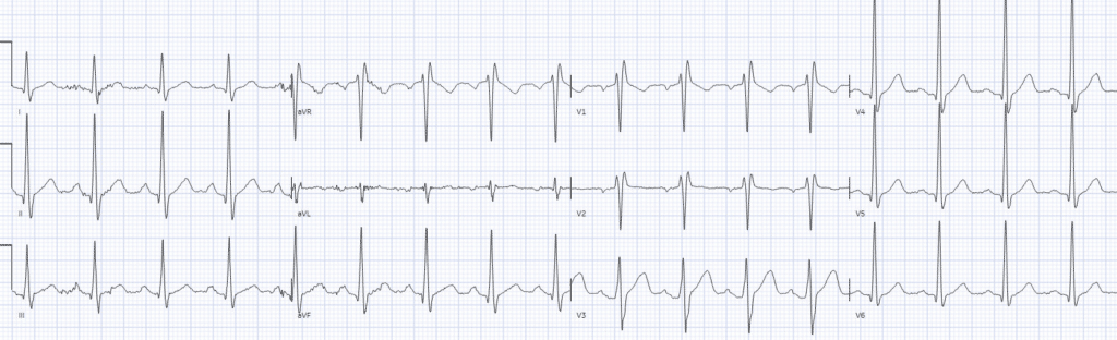 ECG Interpretation in Toxicology | ECG Cases | EM Cases