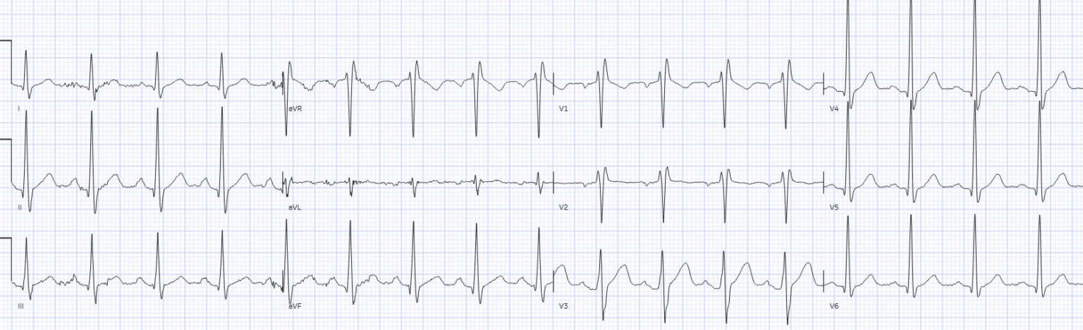 ECG Interpretation in Toxicology | ECG Cases | EM Cases