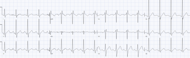ECG Interpretation in Toxicology | ECG Cases | EM Cases